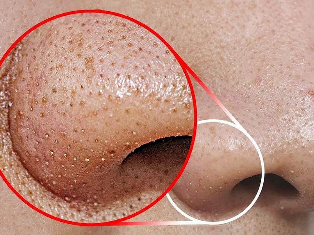 Blackhead removal facial store